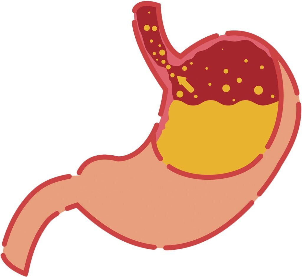 Reducing Intake of Sugars Improves GERD Symptoms - Tufts Health ...